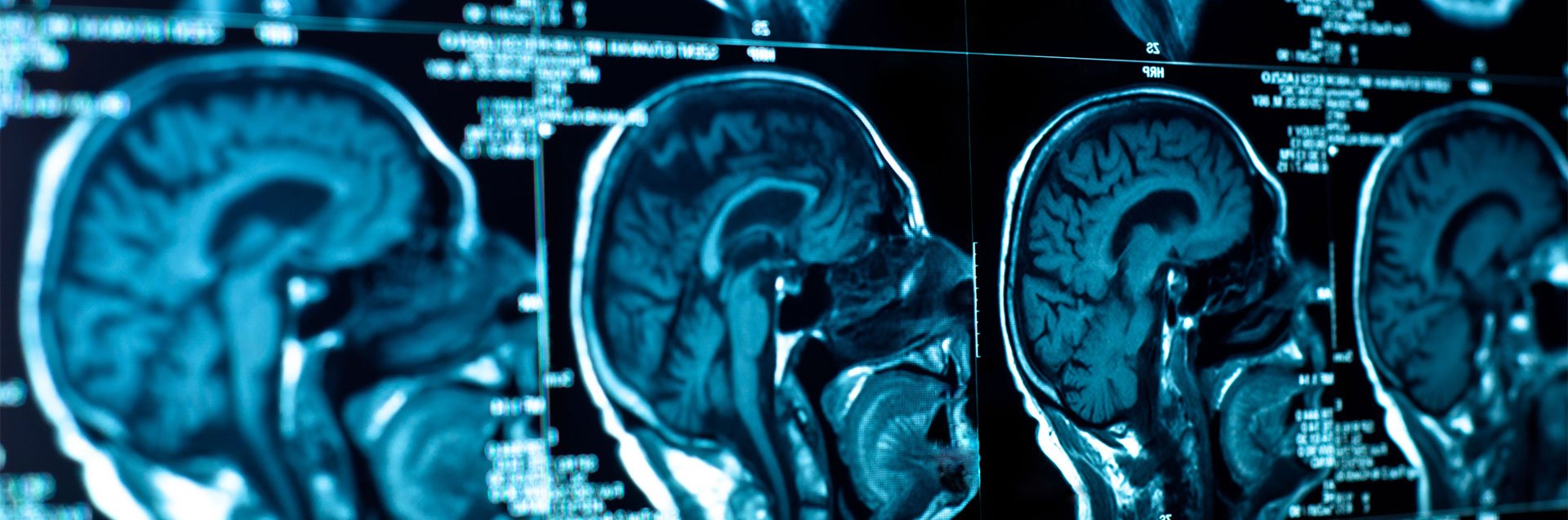 Brain and Spine Injuries | Orlando Personal Injury Lawyers